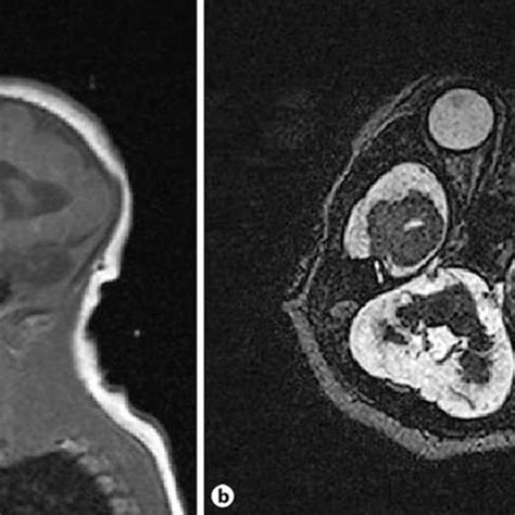 Computed Tomography Scan Showing Subcortical Diffuse Periventricular