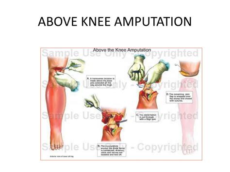 Above Knee Amputation Anatomy Above The Knee Amputation Guide