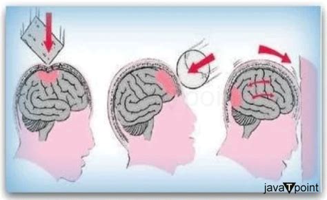 Brain Contusion Tpoint Tech