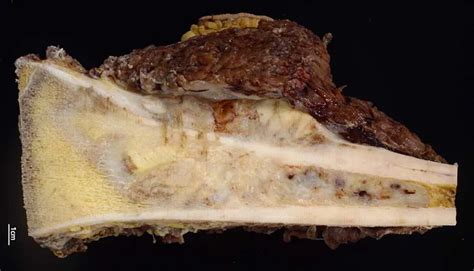 Osteosarcoma Macroscopic Features