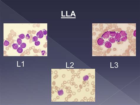 Atlas De Hematología Leucemia Linfoide Aguda