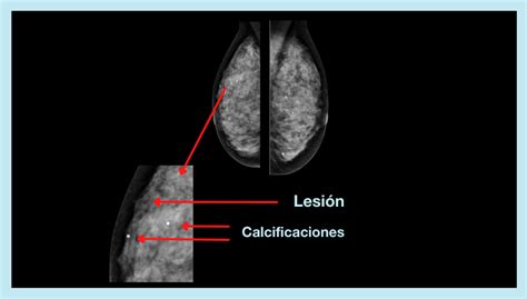 Avances En Radiología Ginecológica Un Caso De Lesión Cutánea Detectada
