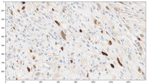Positive Pixel Count And Parallel Processing With Dask — Histomicstk
