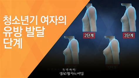 청소년기 여자의 유방 발달 단계 2011 3 12 364회 방송 성장의 과속 성조숙증 Youtube
