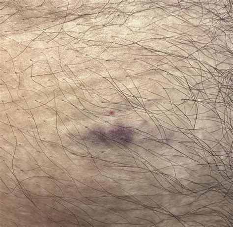 Injection Site Reaction Rozempic