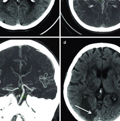 Posterior Cerebral Artery Stroke