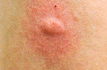German Cockroach Bites Do Cockroaches Bite Risks Behavior And
