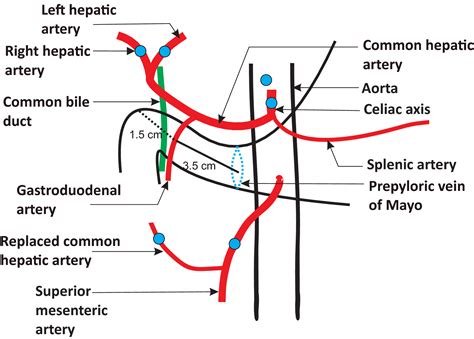 Gastroduodenal Artery