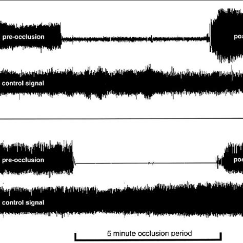 Representative Reactive Hyperaemia Peripheral Arterial Tonometry Download Scientific Diagram
