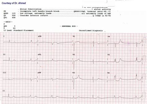 Ecg Challenge From Dr Ahmed Patient With Hyperkalemia Ecg Guru Instructor Resources