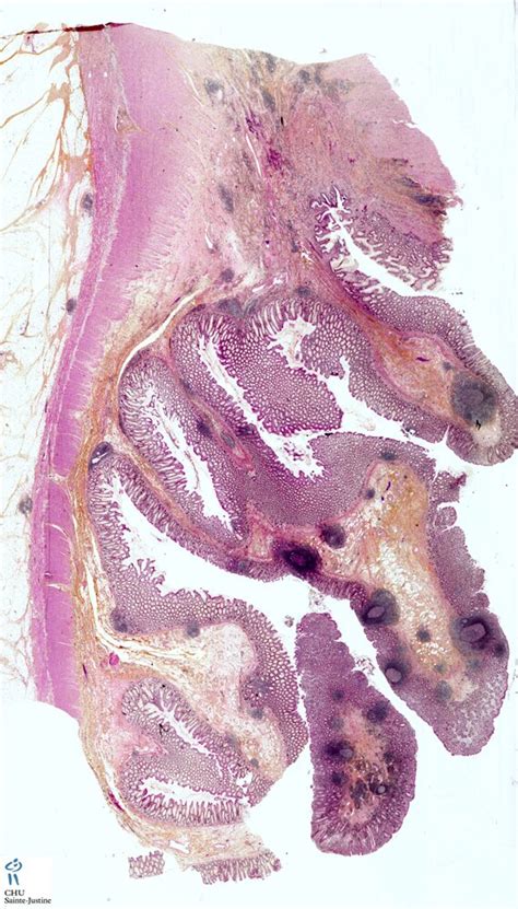 Colorectal Inflammatory Pseudopolyp Human Pathology