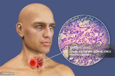 Thyroid Micrograph Photos And Premium High Res Pictures Getty Images