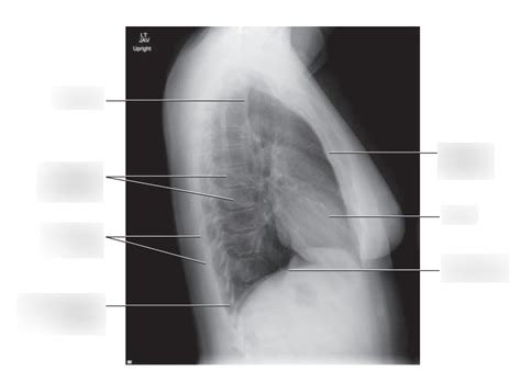 Lateral Chest Rad Diagram Quizlet