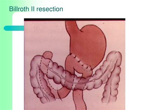 Ppt Diseases Of The Operated Stomach Powerpoint Presentation Free