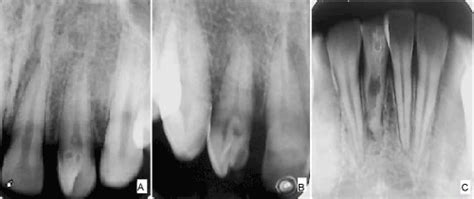 Dens Invaginatus A Radiographic Analysis