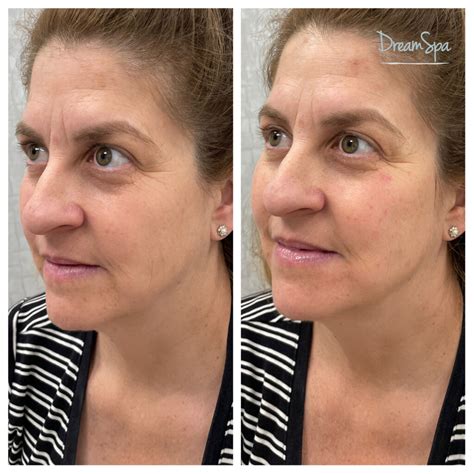 Filler Cheeks Chin 6 Dream Spa Medical