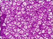 Categoryhistopathology Of Glycogen Storage Disease Wikimedia Commons