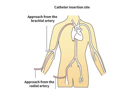 Guide Wire Extrusion Line Everplast