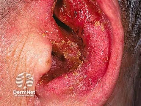 Otitis Externa Images — Dermnet