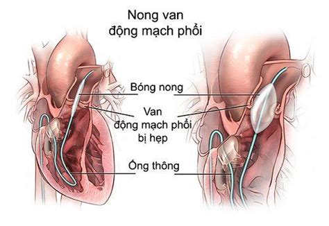 Chỉ định nong hẹp nhánh động mạch phổi Vinmec