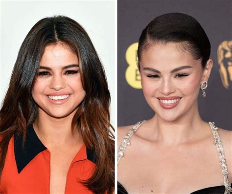 Did Selena Gomez Get Veneers Before And After New Smile Betches
