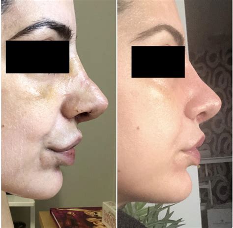 Swelling Progression 6 Weeks Post Revision Rhinoplasty Scrolller