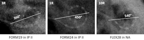 Test Electrode Based Estimation Of Achievable Insertion Depth In