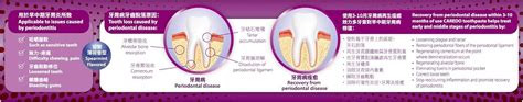 Caredo Healing Periodontitis Treatment Toothpaste Gingivitis And Gum