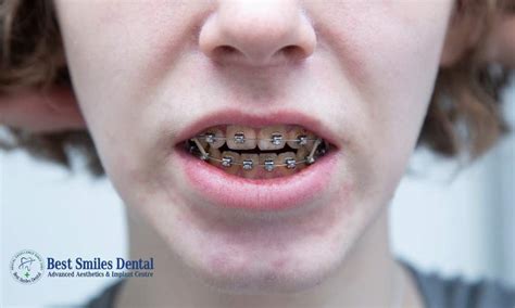 Bite Correction Therapy In Koramangala Bengaluru