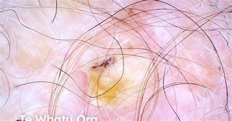 Erosive Pustular Dermatosis Of The Scalp Image