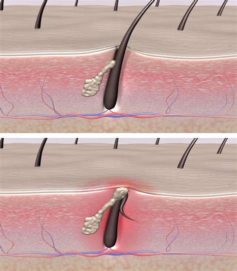 How To Prevent Ingrown Hairs After Waxing — Rejuvenate You
