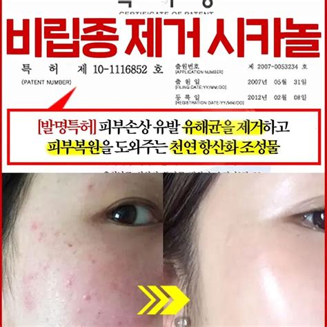 Essencecream 비립종제거크림메디필메디필시카놀좁쌀여드름재생크림 On Bunjang Global Site