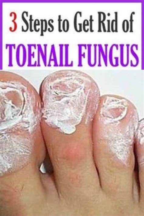 Toenail Fungus Removal Treatment Artofit