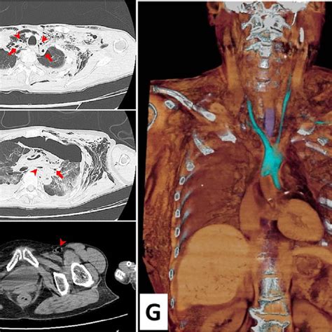 Cutaneous Angiosarcoma Of Scalp Measuring 6╳45cm In Size Was Confirmed
