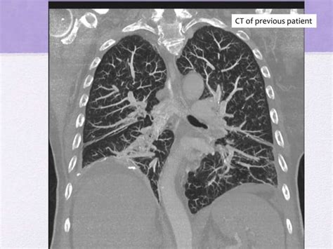 Cxr Interpretation Ppt