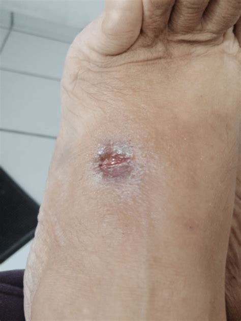 Bug Bite In Mexico R Bugbites