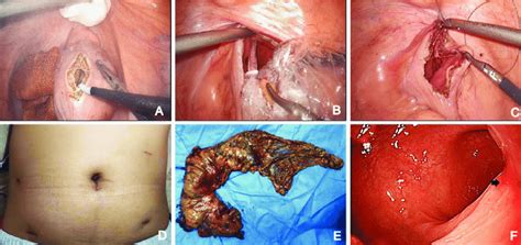Laparoscopic Radical Right Hemicolectomy With Transrectal Specimen