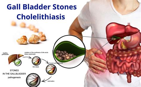 Gallstones In Gallbladder