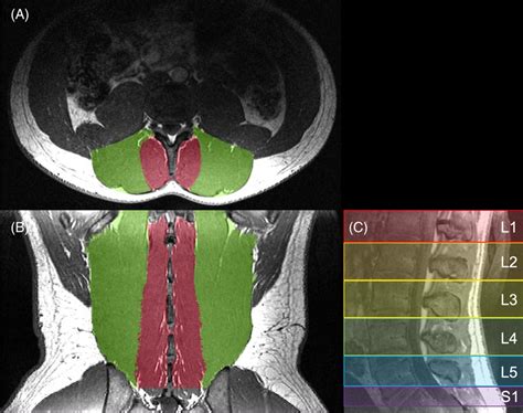 Sample Anatomical Mris Used For Segmentation Of The Multifidus Red Download Scientific