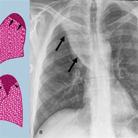 Drawing Of The Left Lower Lobe Lll Collapse A Resembling What Download Scientific Diagram