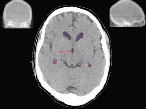 Basal Cisterns Axial Ct
