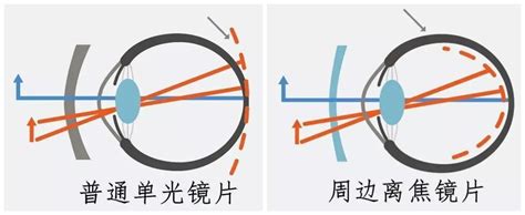 近视防控新研究离焦眼镜 健康教育 清华大学附属北京清华长庚医院眼科