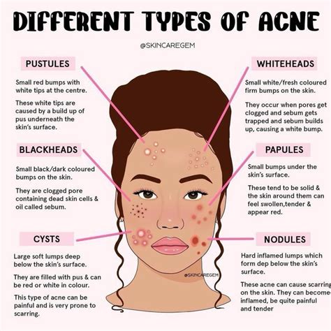 What Your Acne Might Be Telling You Face Mapping Acne Face Acne