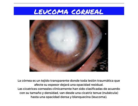 Resúmenes De Leucoma Corneal Descarga Apuntes De Leucoma Corneal