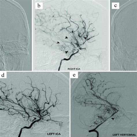 A D Axial Image Of Non Contrast Ct Brain Fig 1a B Taken At The Download Scientific Diagram