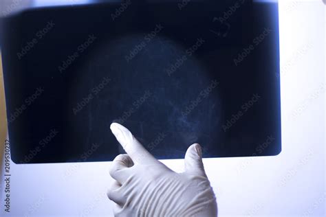 Xray Breast Scan Mammogram Stock Photo Adobe Stock