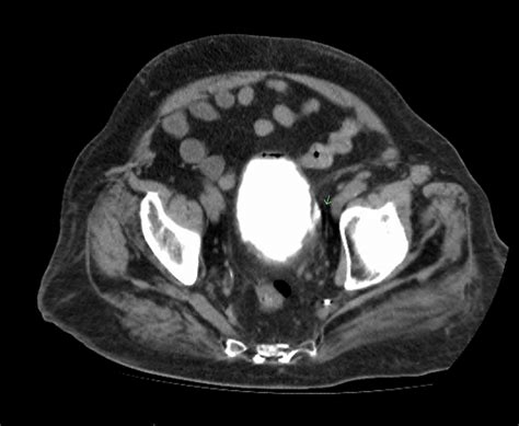 Ct Cystogram Confirms Bladder Perforation In The Left Lateral Wall