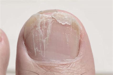 Common Nail Conditions Diagnosis And Treatment Options
