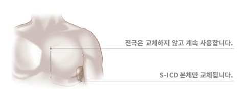 Emblem S Icd의 교체 Emblem S Icd