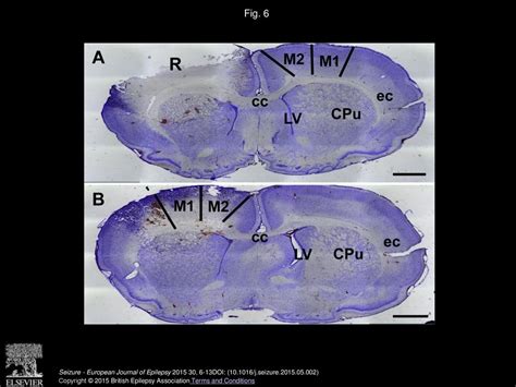 Reduction Of Epileptiform Activity Through Local Valproate Implants In A Rat Neocortical